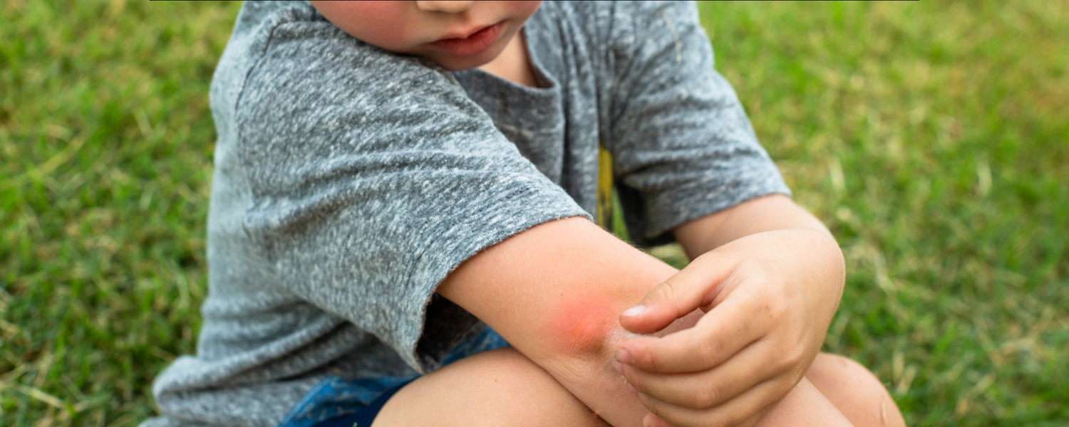 What Is an Overactive Histamine Response to Bug Bites? – Fact vs Fitness